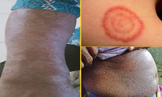 Apa Itu Tinea Imbrikata atau Kaskado ? | Papuaposnabire - Baca! Biar Ko Tau